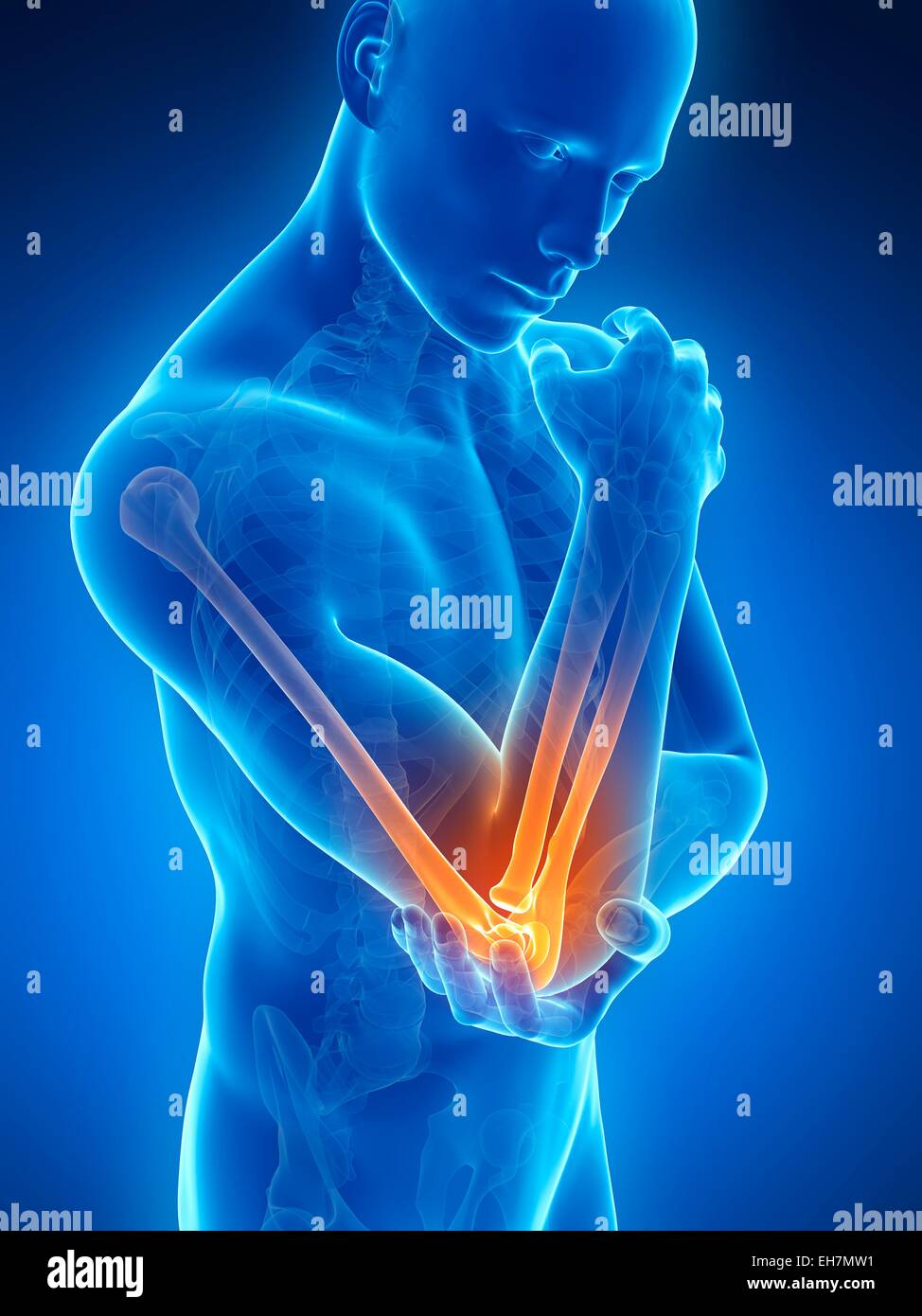 Human elbow pain, illustration Stock Photo - Alamy