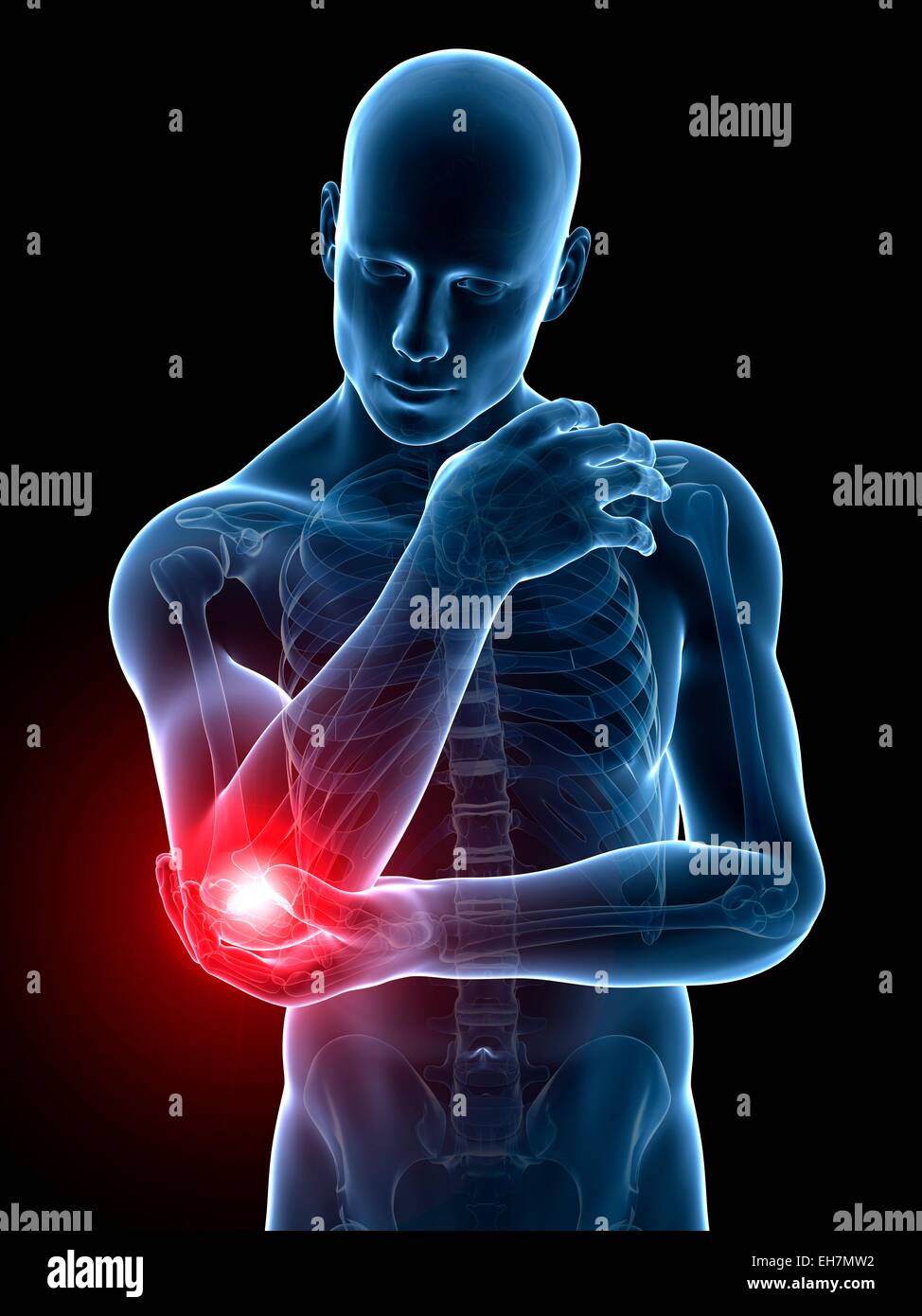 Human elbow pain, illustration Stock Photo - Alamy