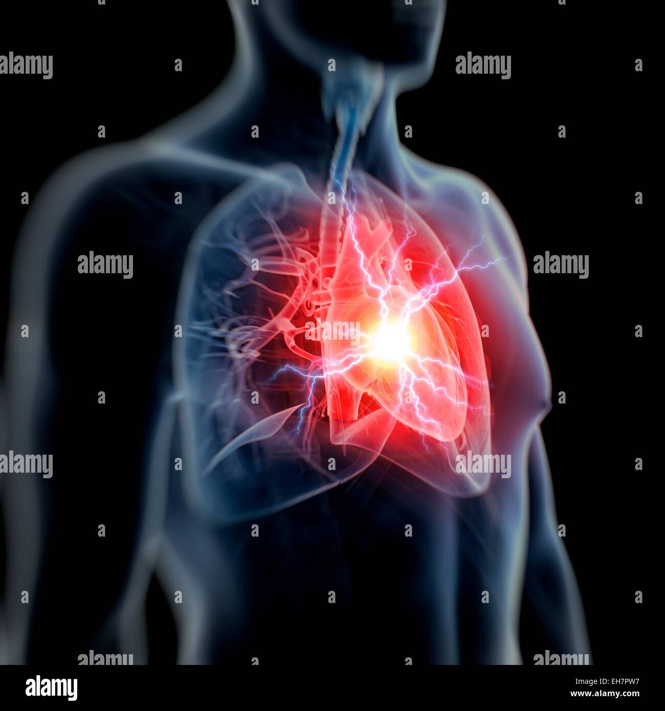 Human heart attack, illustration Stock Photo - Alamy