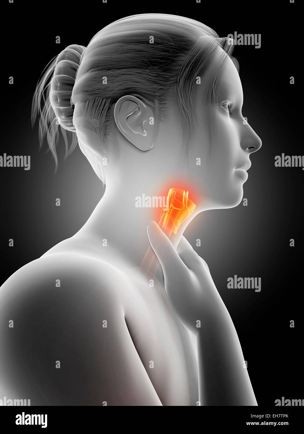 Inflammation of the larynx, illustration Stock Photo - Alamy
