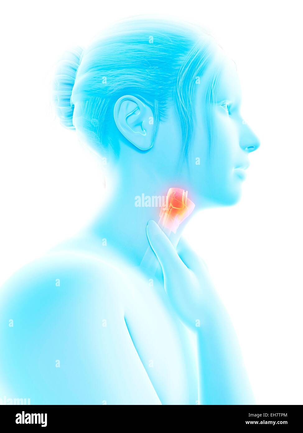 Inflammation of the larynx, illustration Stock Photo - Alamy