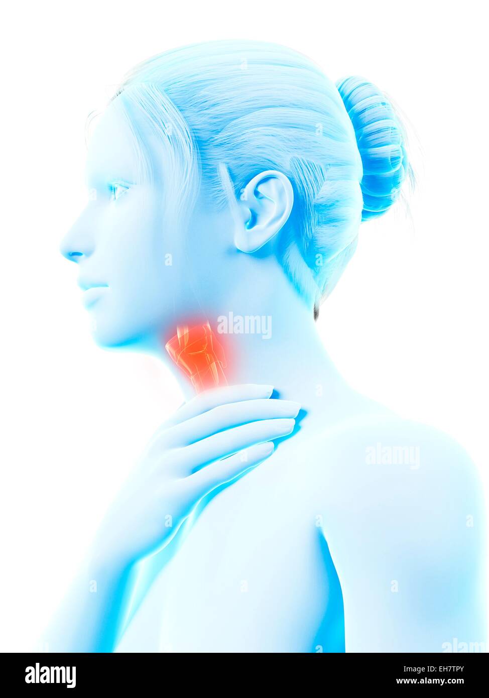 Inflammation of the larynx, illustration Stock Photo - Alamy