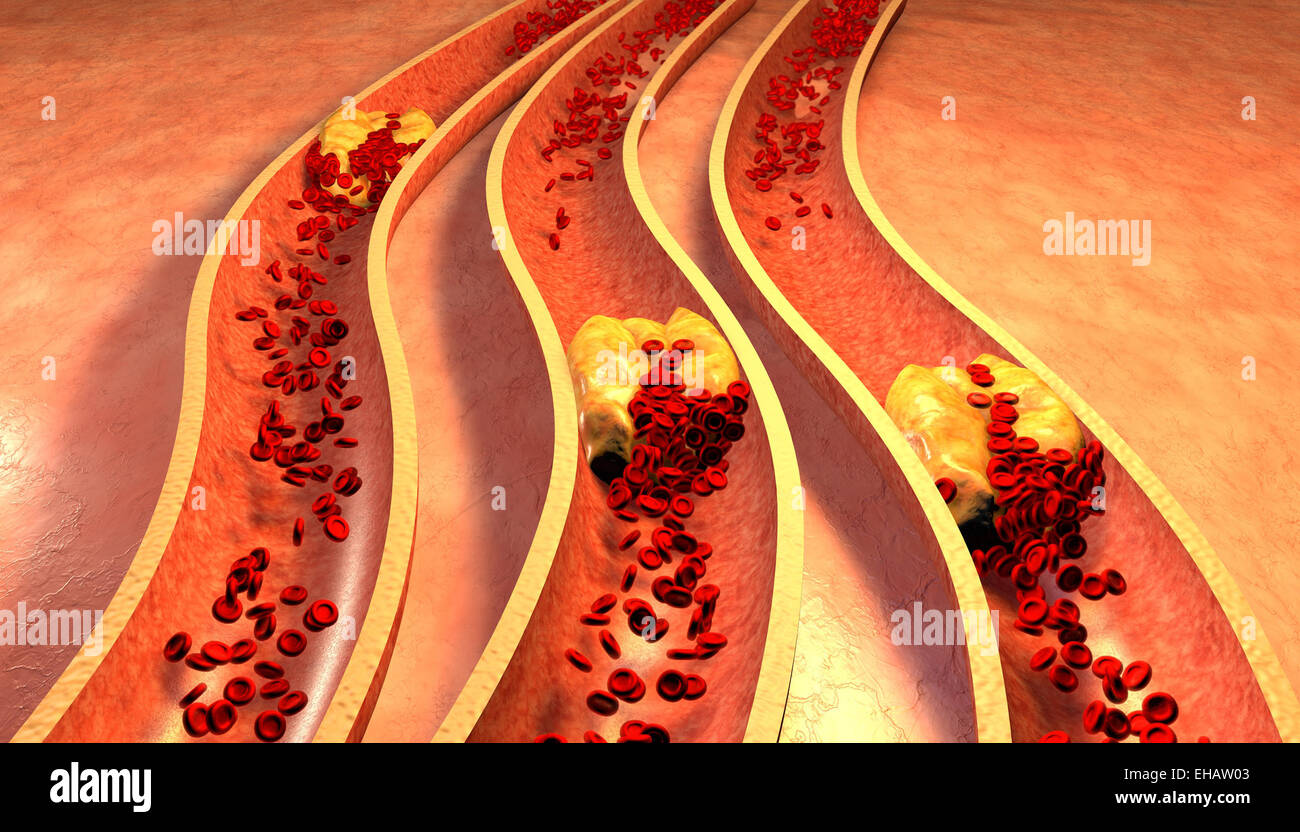 Clogged Artery with platelets and cholesterol plaque Stock Photo - Alamy