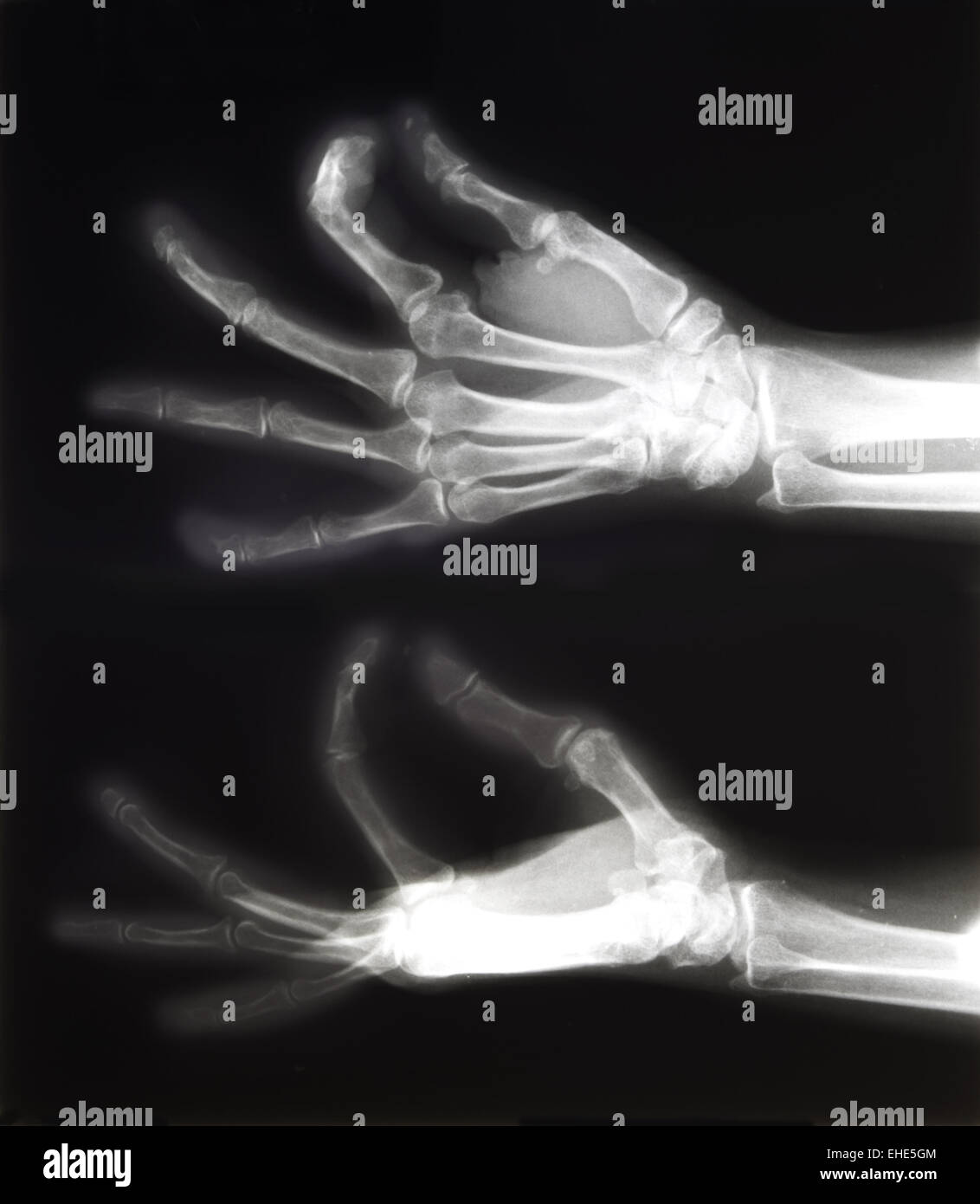 X-ray of hands Stock Photo - Alamy