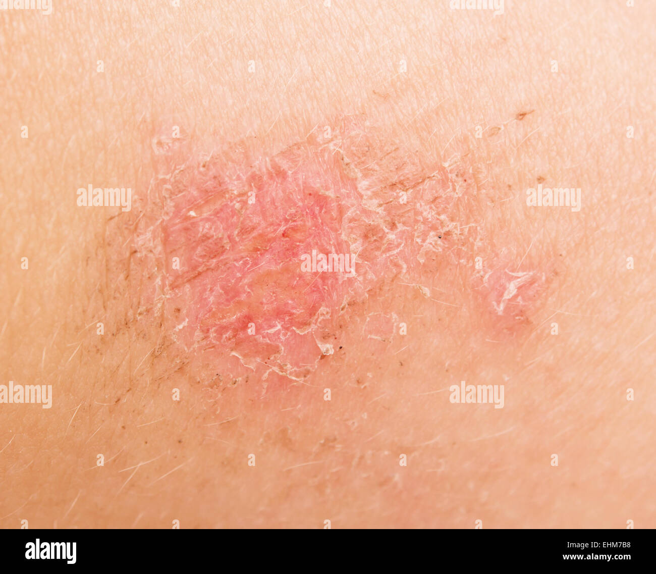 wound on human skin Stock Photo - Alamy