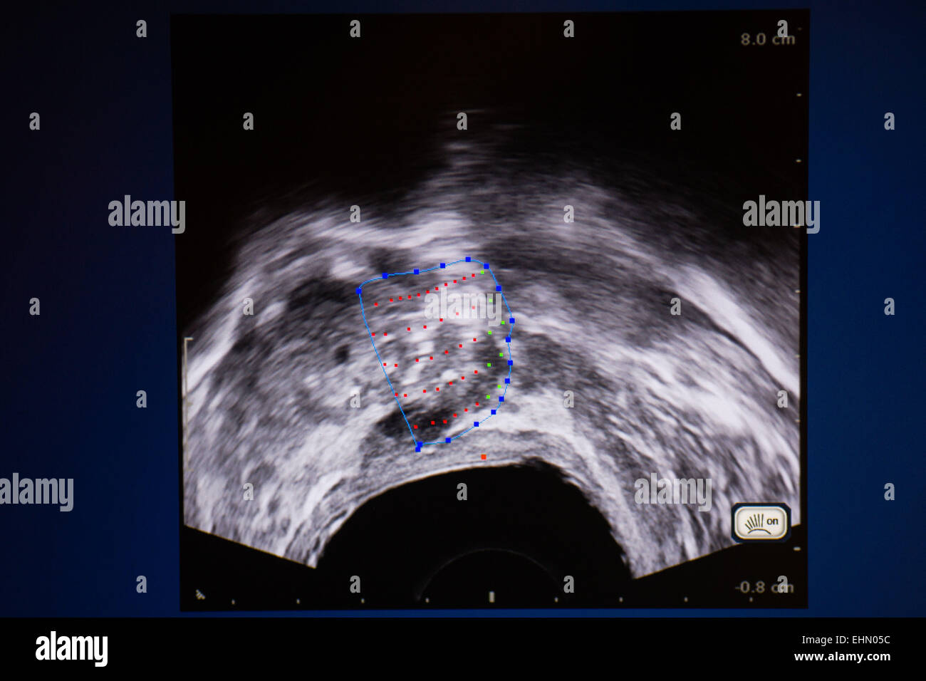 Cancer prostate ultrasound hi-res stock photography and images - Alamy