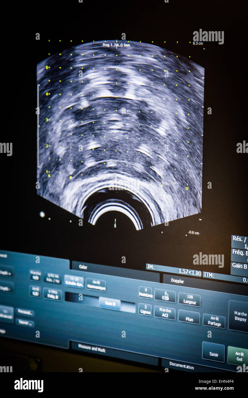 Prostate cancer radiotherapy surgery. Radiologist inserting a hollow ...