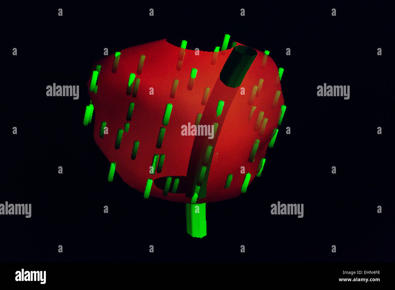 Prostate cancer radiotherapy surgery. Radiologist inserting a hollow ...