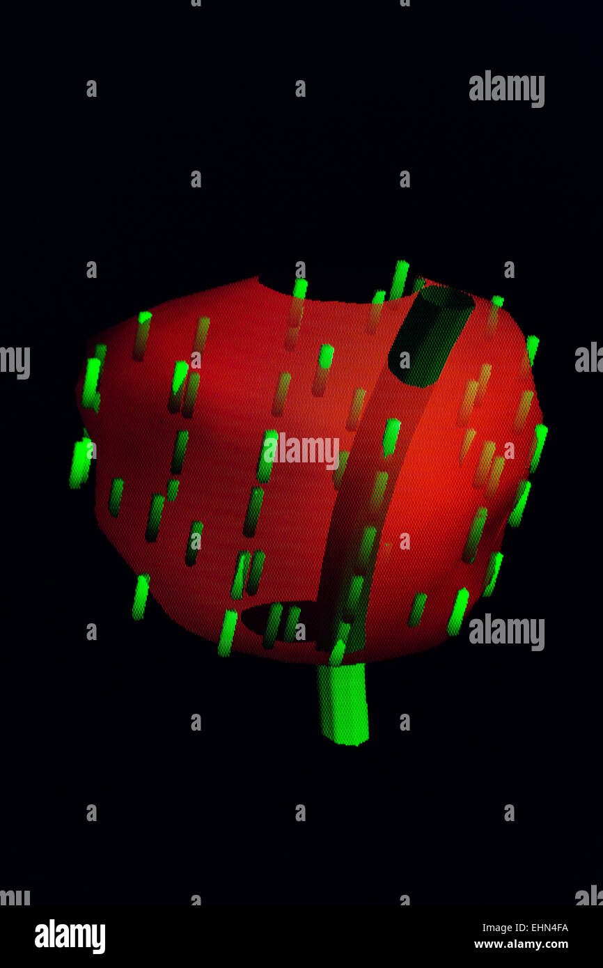 Prostate cancer radiotherapy surgery. Radiologist inserting a hollow ...