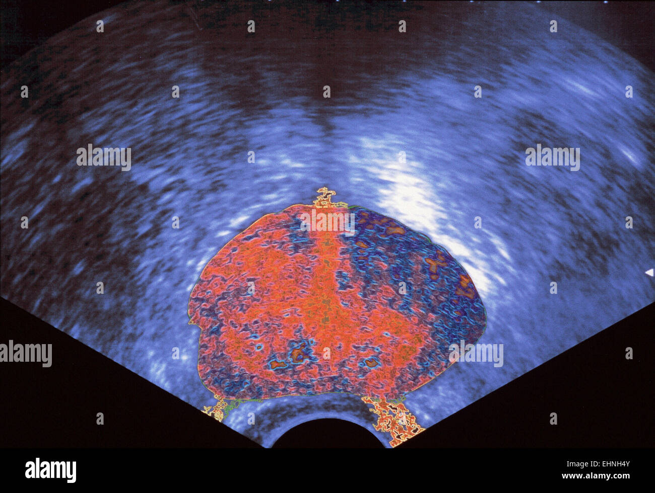 Ultrasound scan of the prostate Stock Photo - Alamy