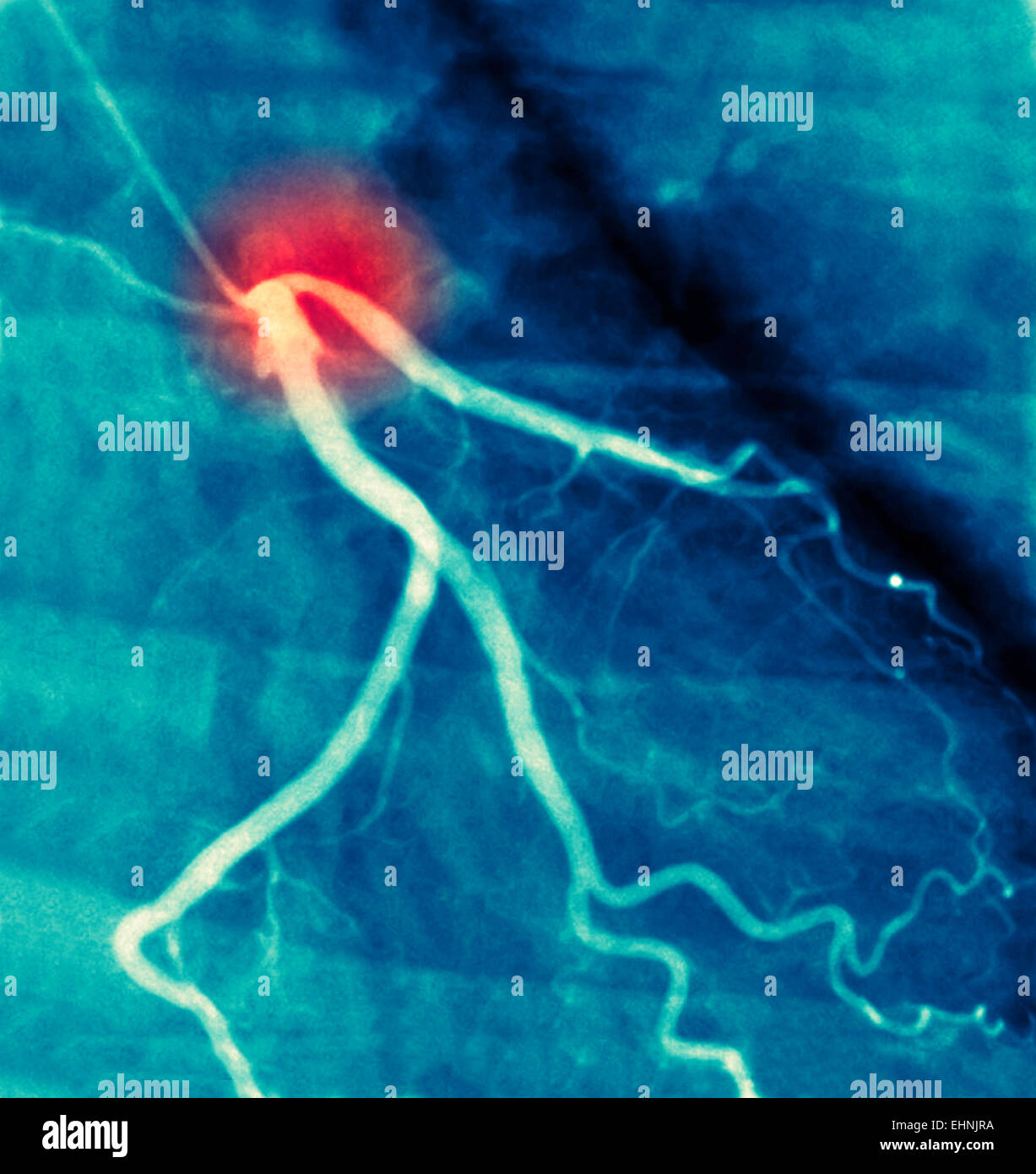 Coronary angiogram hi-res stock photography and images - Alamy