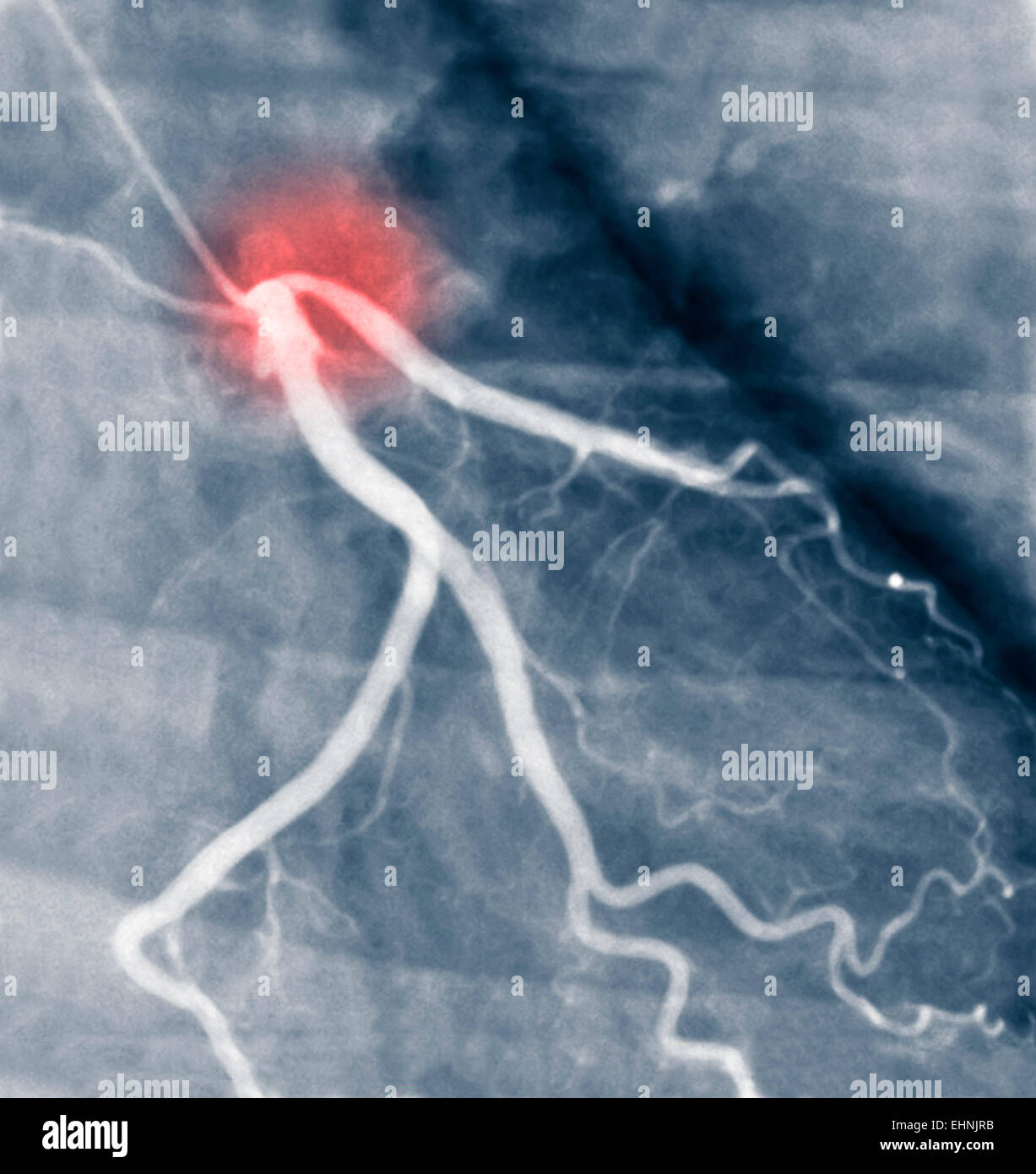 Coronary Angiogram High Resolution Stock Photography and Images - Alamy