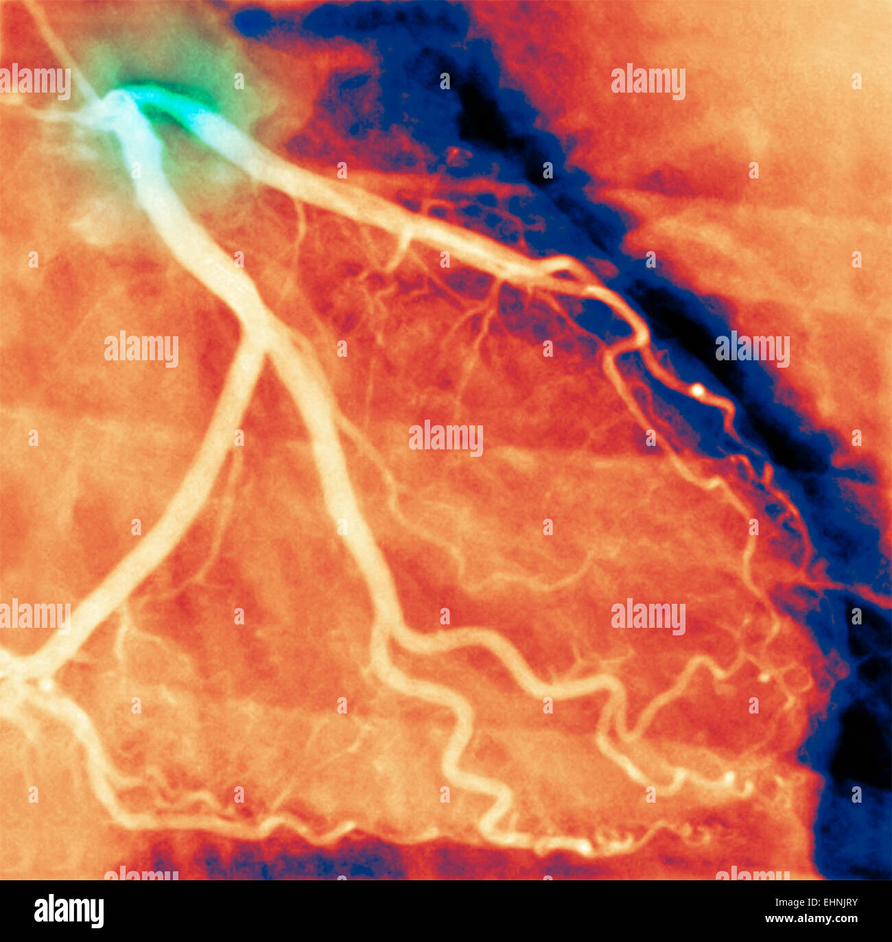 Coronary angiogram hi-res stock photography and images - Alamy