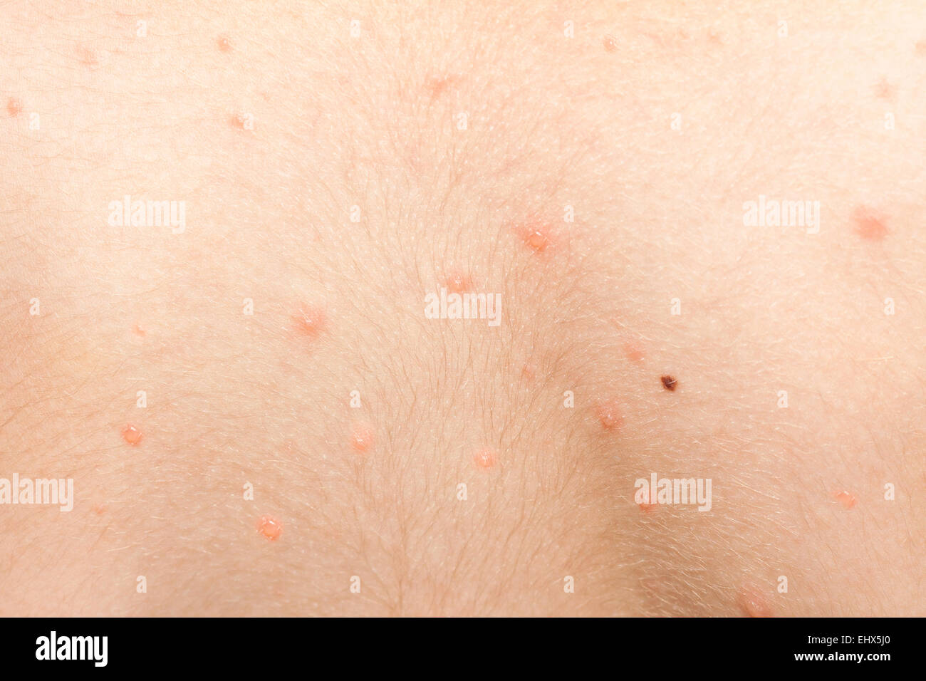 Varicella Rash