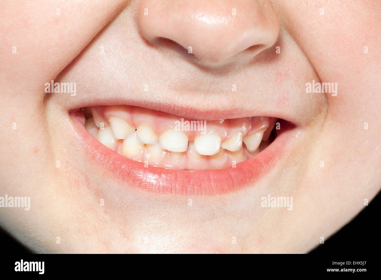 child teeth close up Stock Photo - Alamy