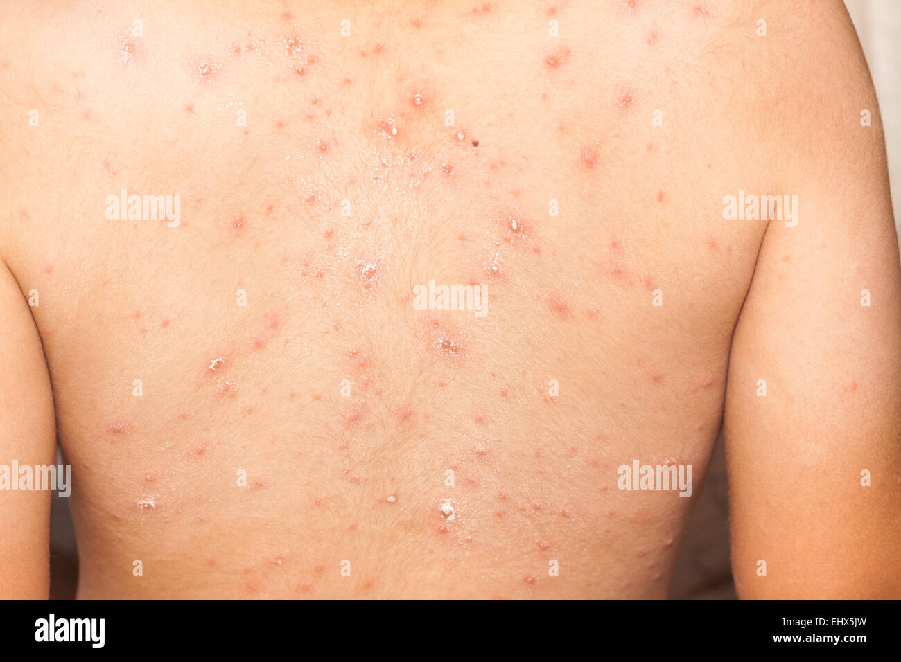 Detail baby with chicken pox rash Stock Photo - Alamy