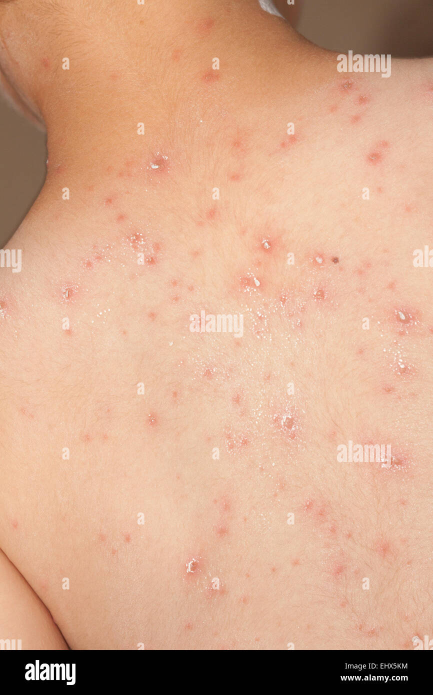 Detail baby with chicken pox rash Stock Photo - Alamy