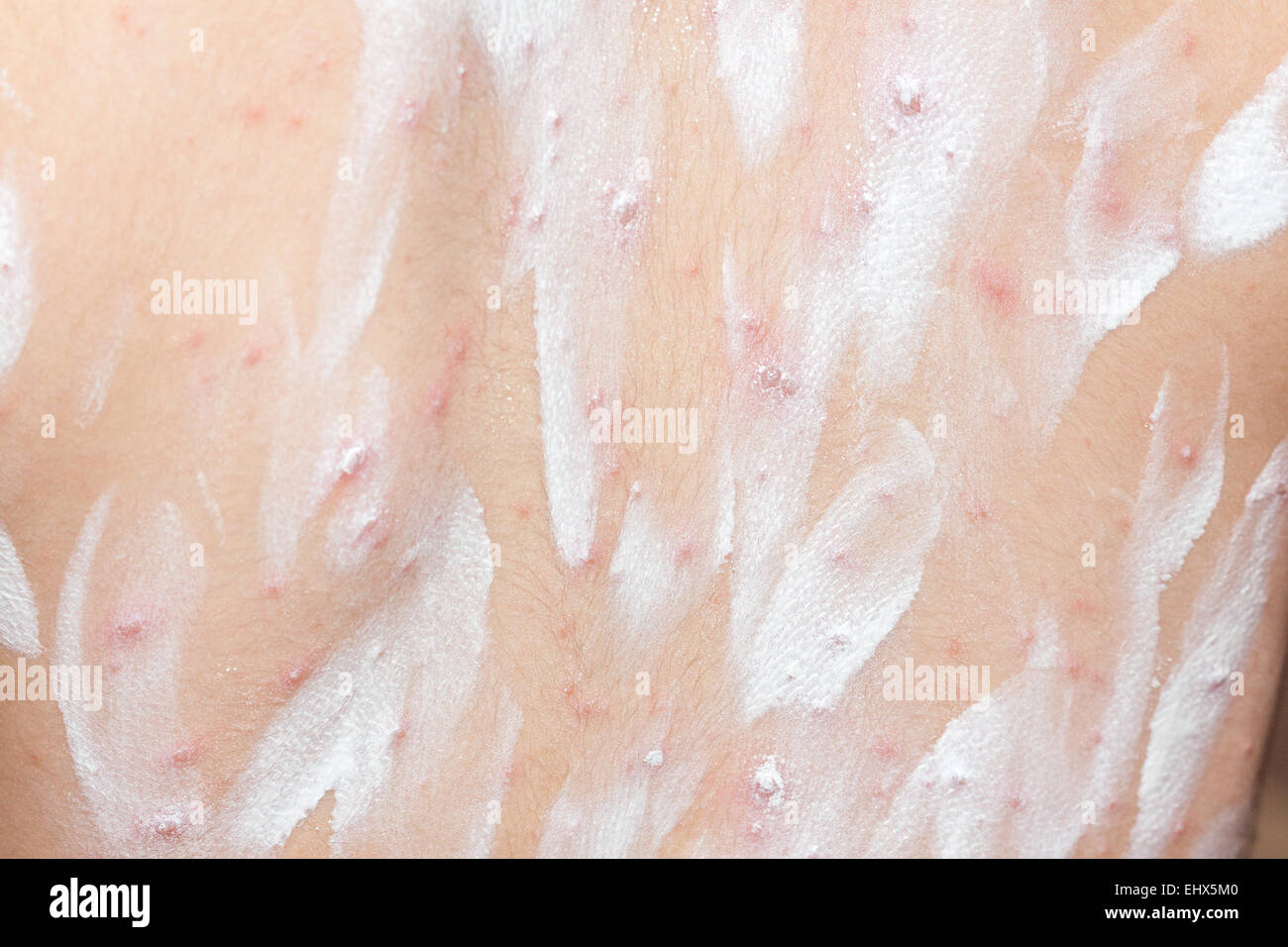 Detail baby with chicken pox rash Stock Photo - Alamy