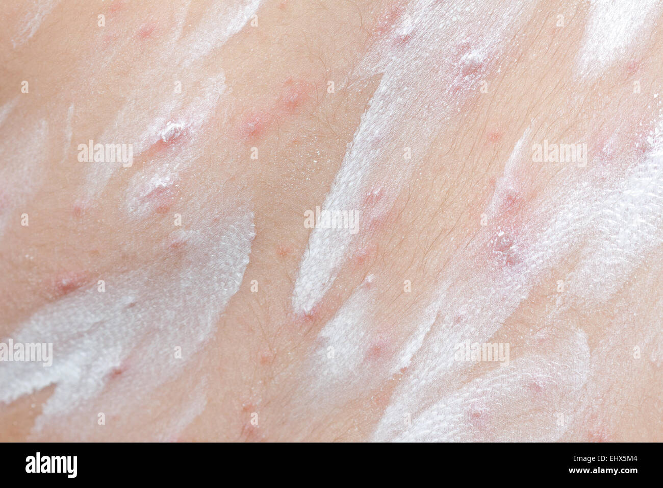 Detail baby with chicken pox rash Stock Photo - Alamy