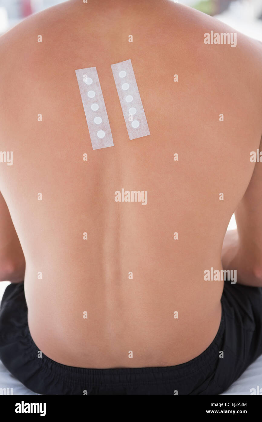 Patient with skin test in his back Stock Photo - Alamy