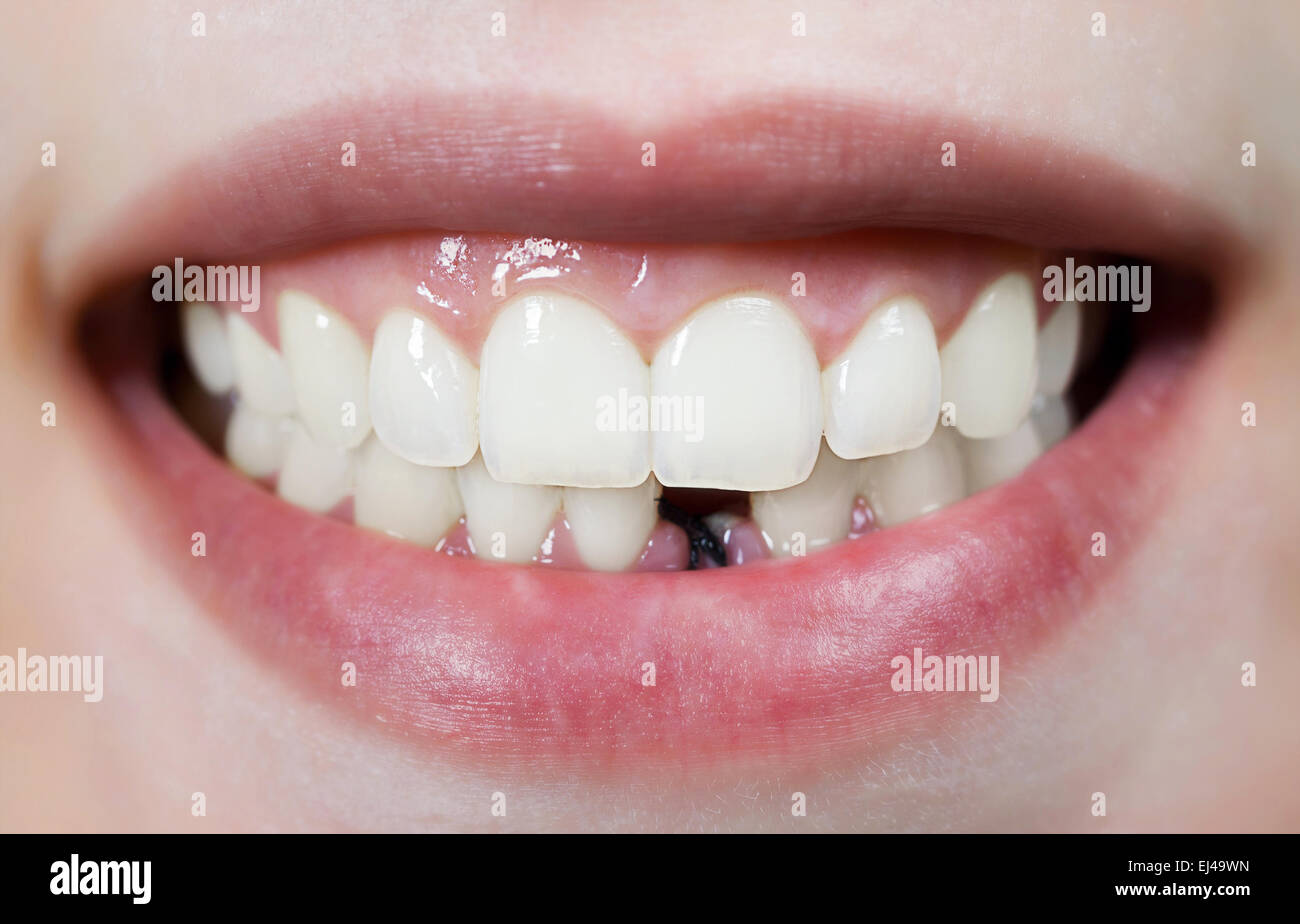 Smile without front tooth Stock Photo - Alamy
