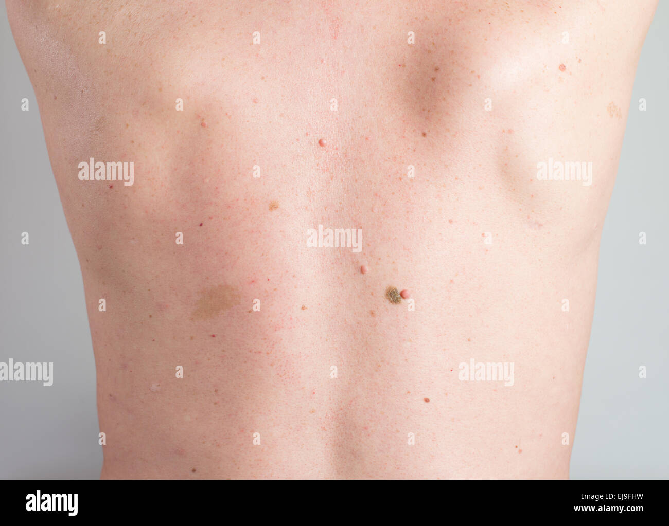 Birthmark hi-res stock photography and images - Alamy