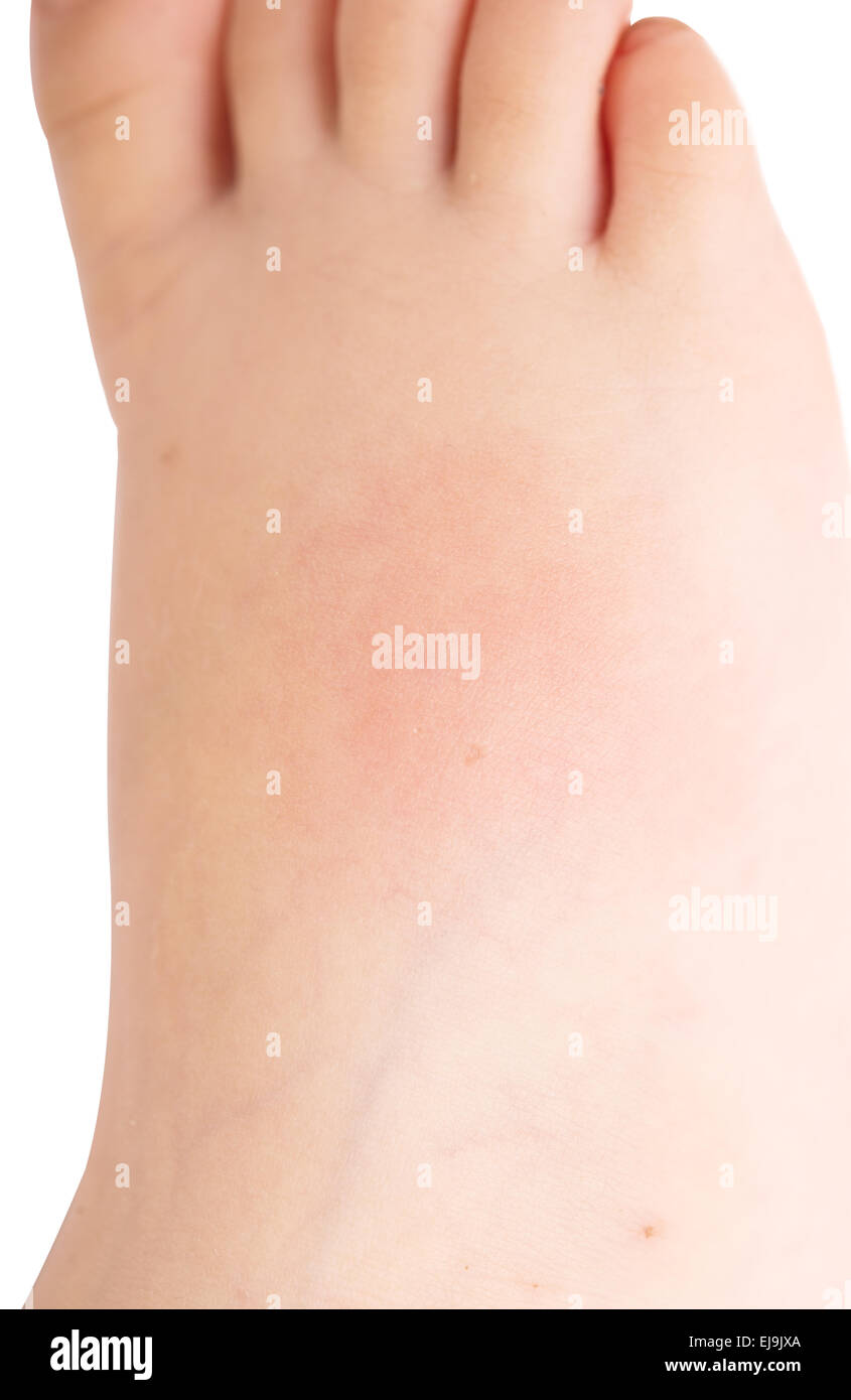 Swollen foot hi-res stock photography and images - Alamy