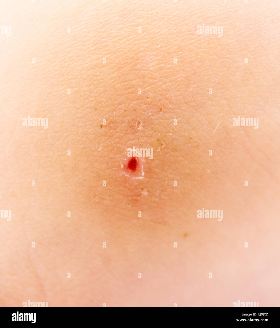 Insect wound hi-res stock photography and images - Alamy
