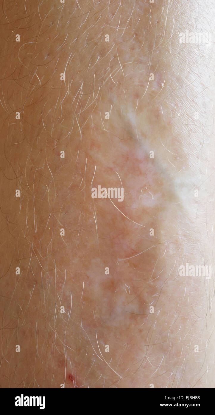 scar on skin Stock Photo - Alamy