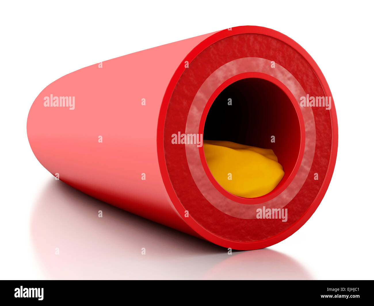 Cholesterol plaque hi-res stock photography and images - Alamy