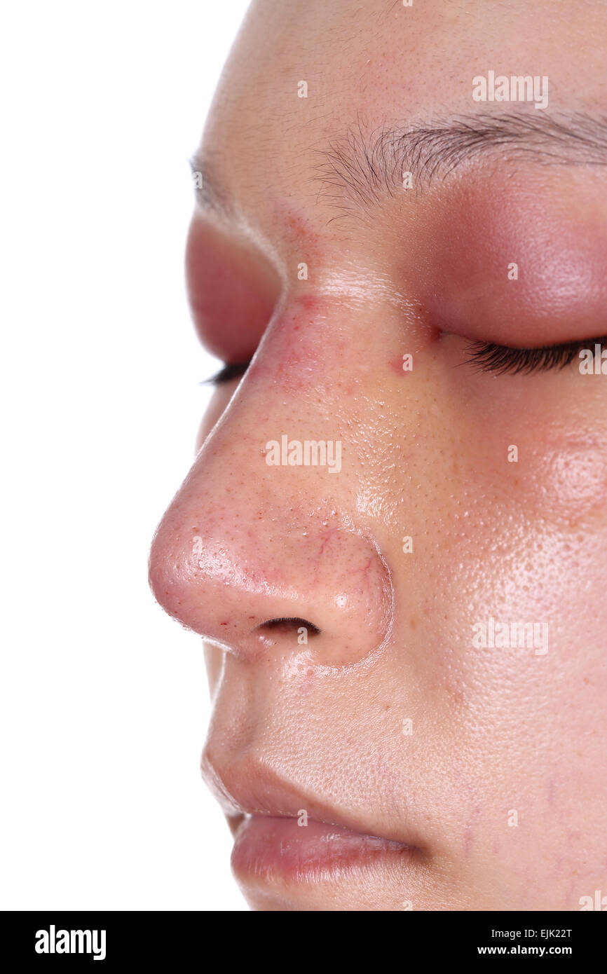 Swelling nose hi-res stock photography and images - Alamy