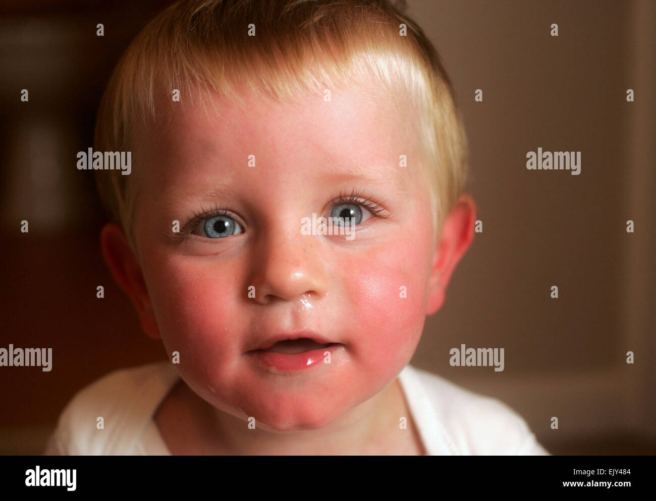 Baby Allergic Reaction Rash On Face