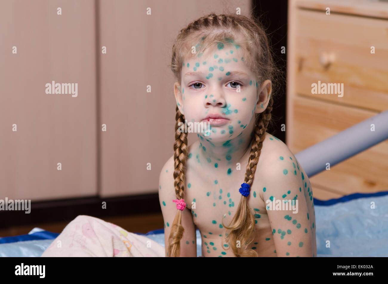 The little girl suffering from chicken pox is covered by green dots ...