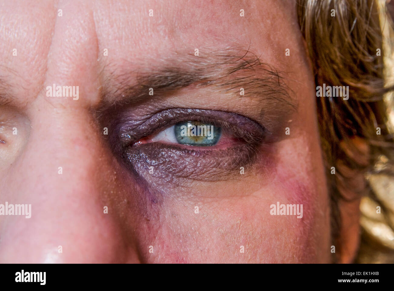 man with black eye Stock Photo - Alamy