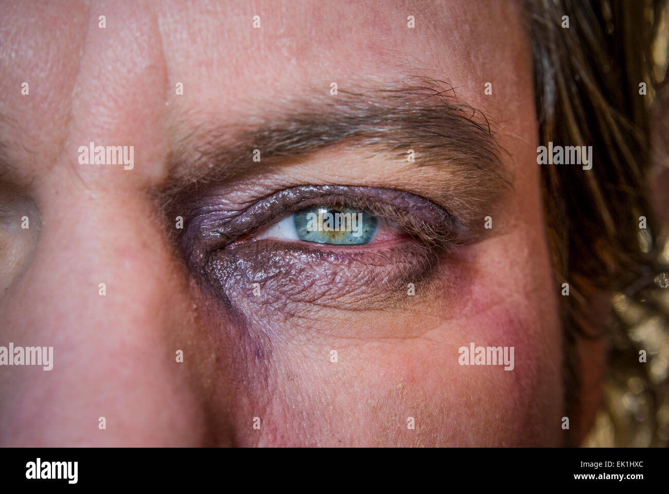 Close-up of a person’s eye with a black eye, showing signs of bruising ...