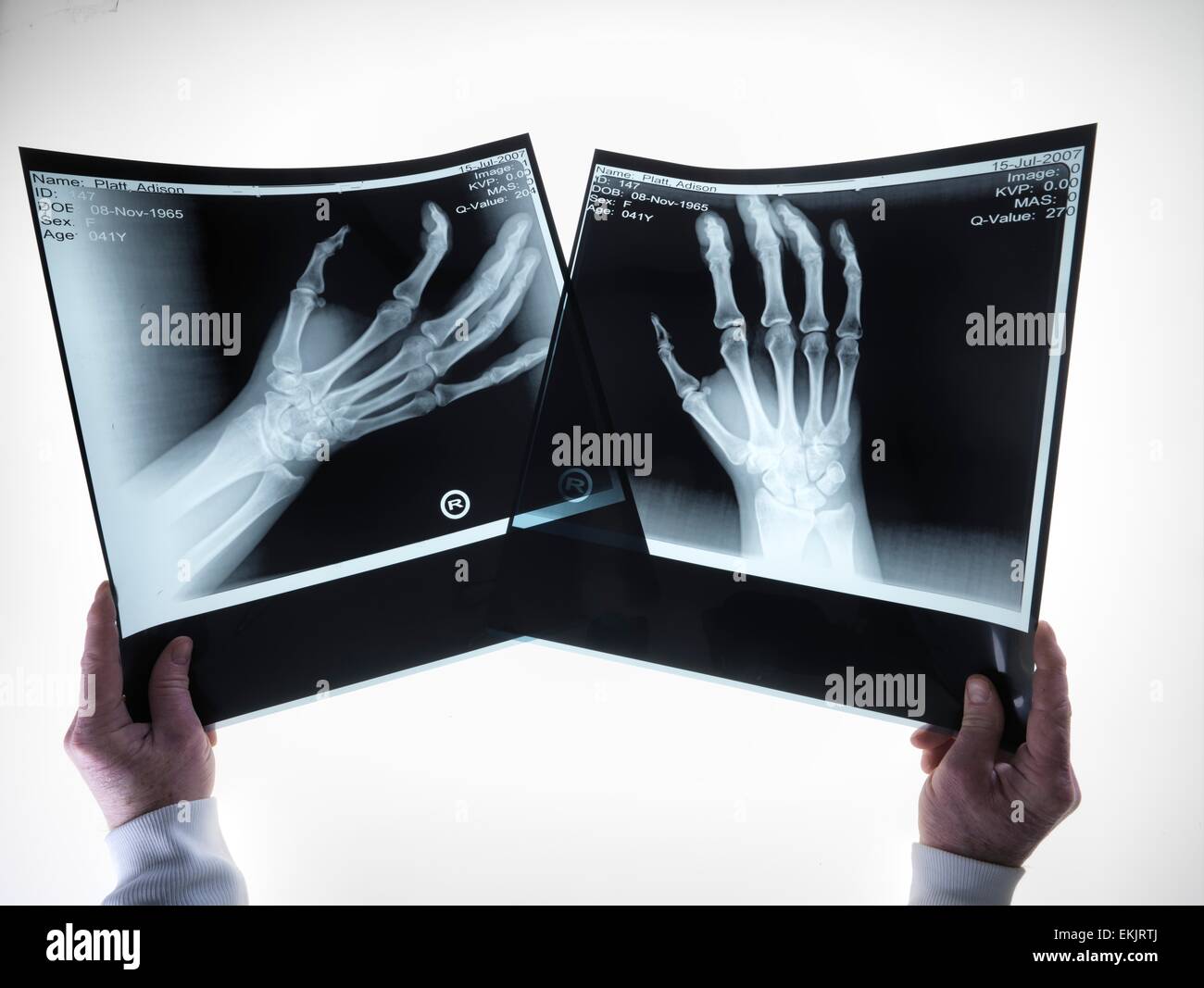 adult, bones, caucasian, diagnosis, diagnostic, doctor, hand, human ...