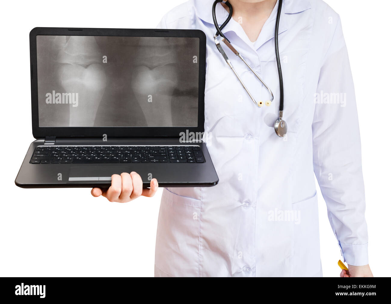 nurse holds computer laptop with X-ray picture of human knee joint on ...
