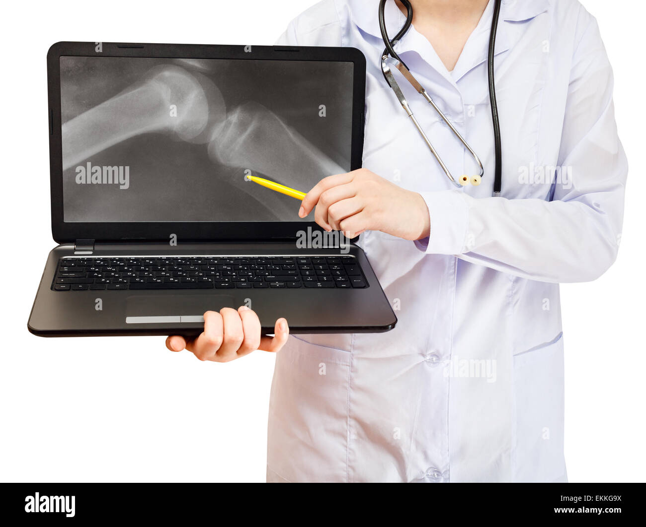 nurse points on computer laptop with X-ray picture of human knee joint ...