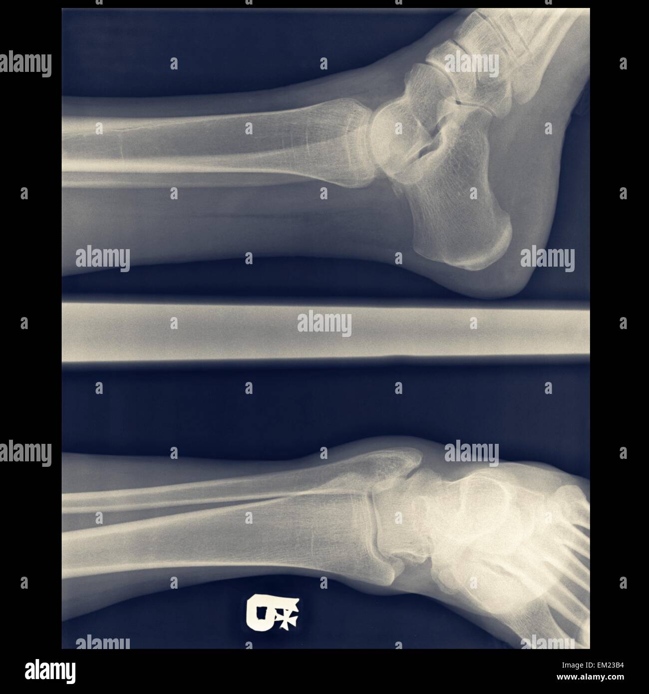 earing of the joint capsule of legs on authentic x-ray picture fracture ...