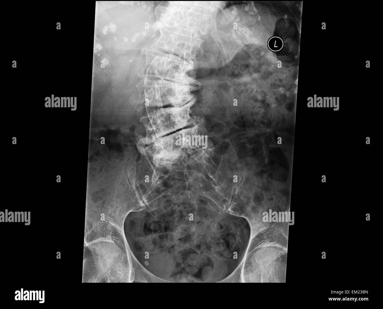 spine scoliosis of elderly woman with osteoporosis decease x-rays Stock ...