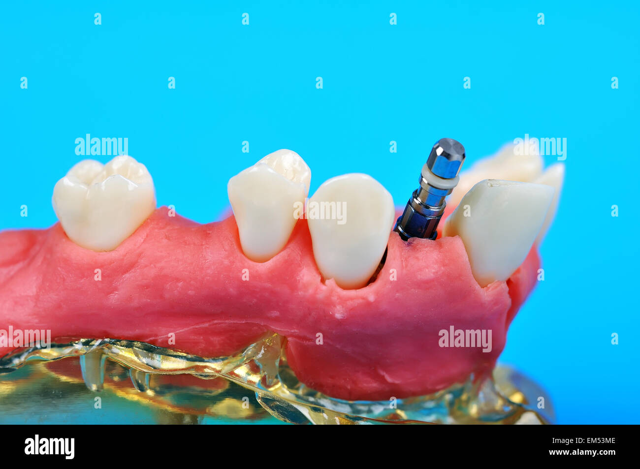 Dental titanium implant implanted in jaw bone isolate in blue Stock ...