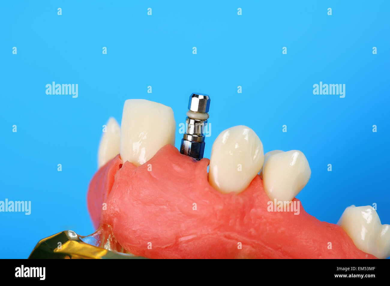 Dental titanium implant implanted in jaw bone isolate in blue Stock ...
