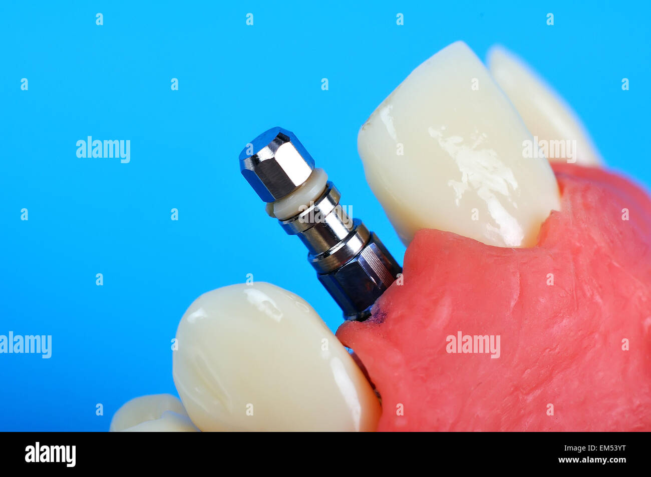 Dental Titanium Alloy