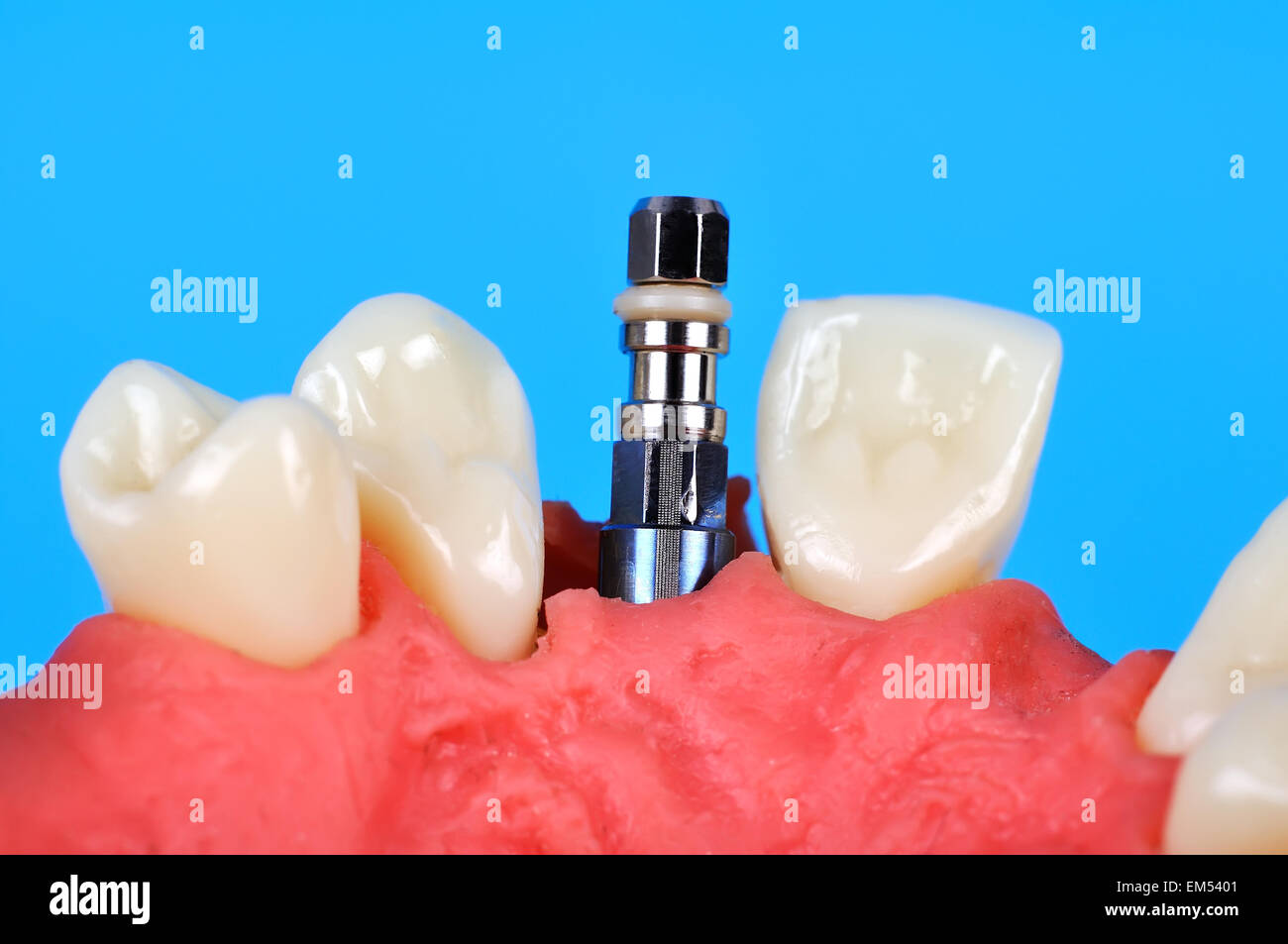 Dental implant implanted in jaw bone, close up Stock Photo - Alamy