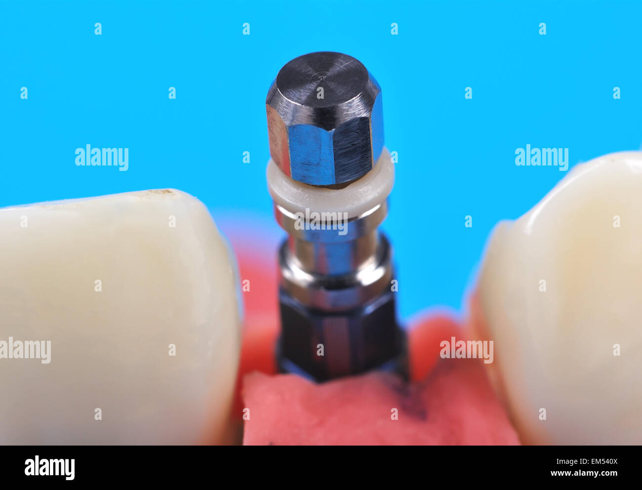 titanium implant implanted in jaw bone isolate in blue Stock Photo - Alamy
