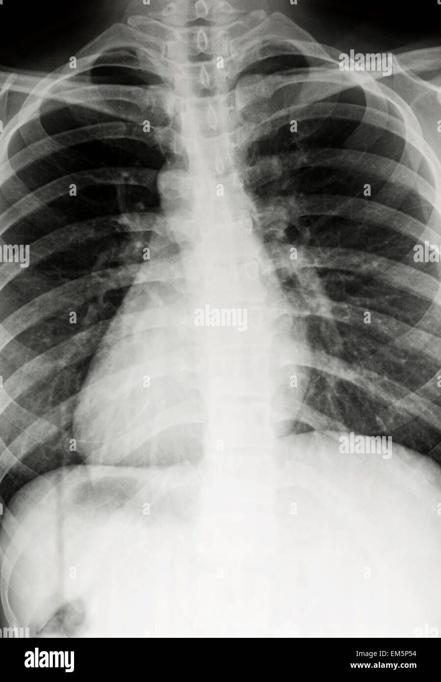 Chest bone hi-res stock photography and images - Alamy