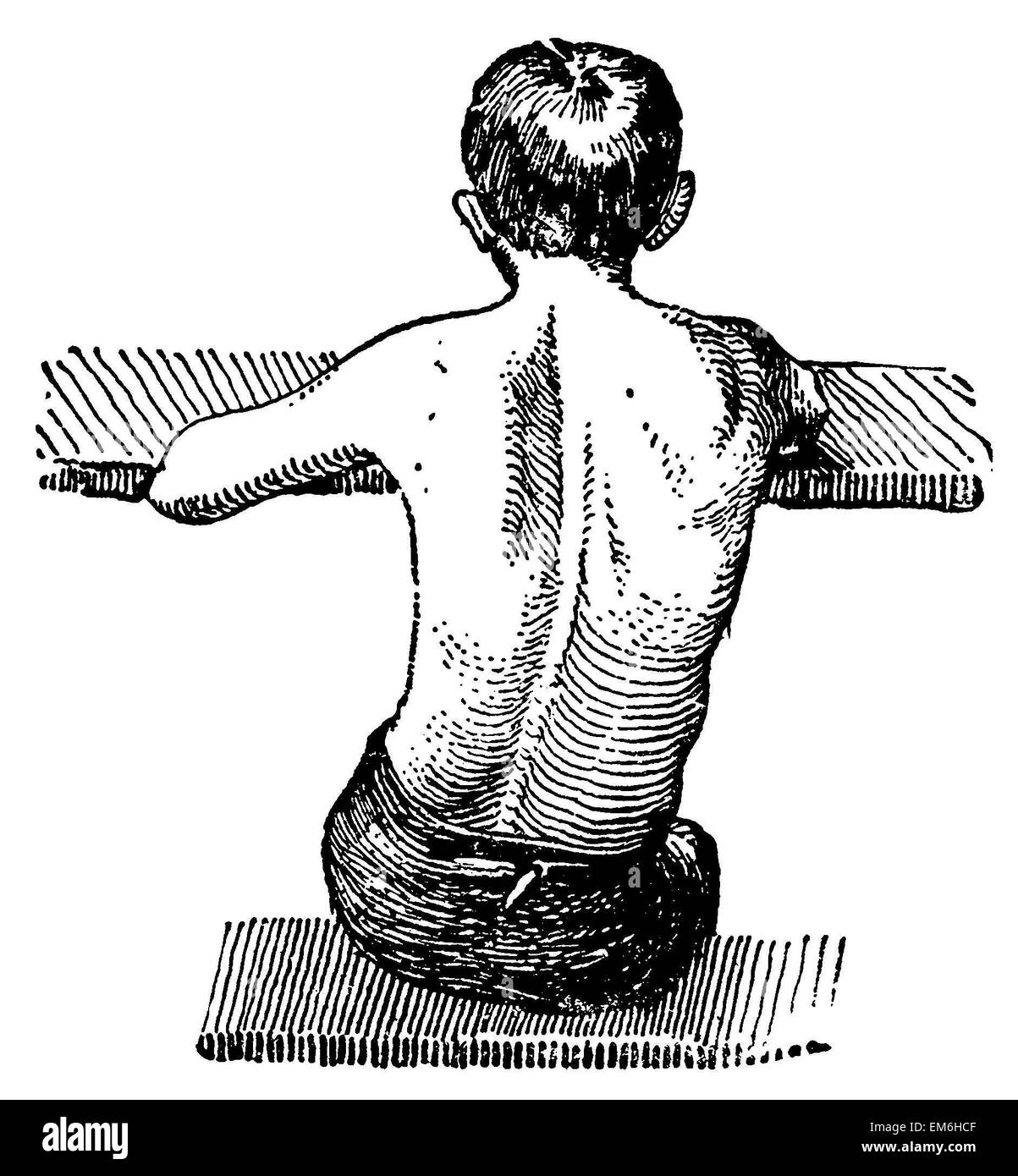 Real Life Hunchback With 100 Degrees Curved Spine Has 100