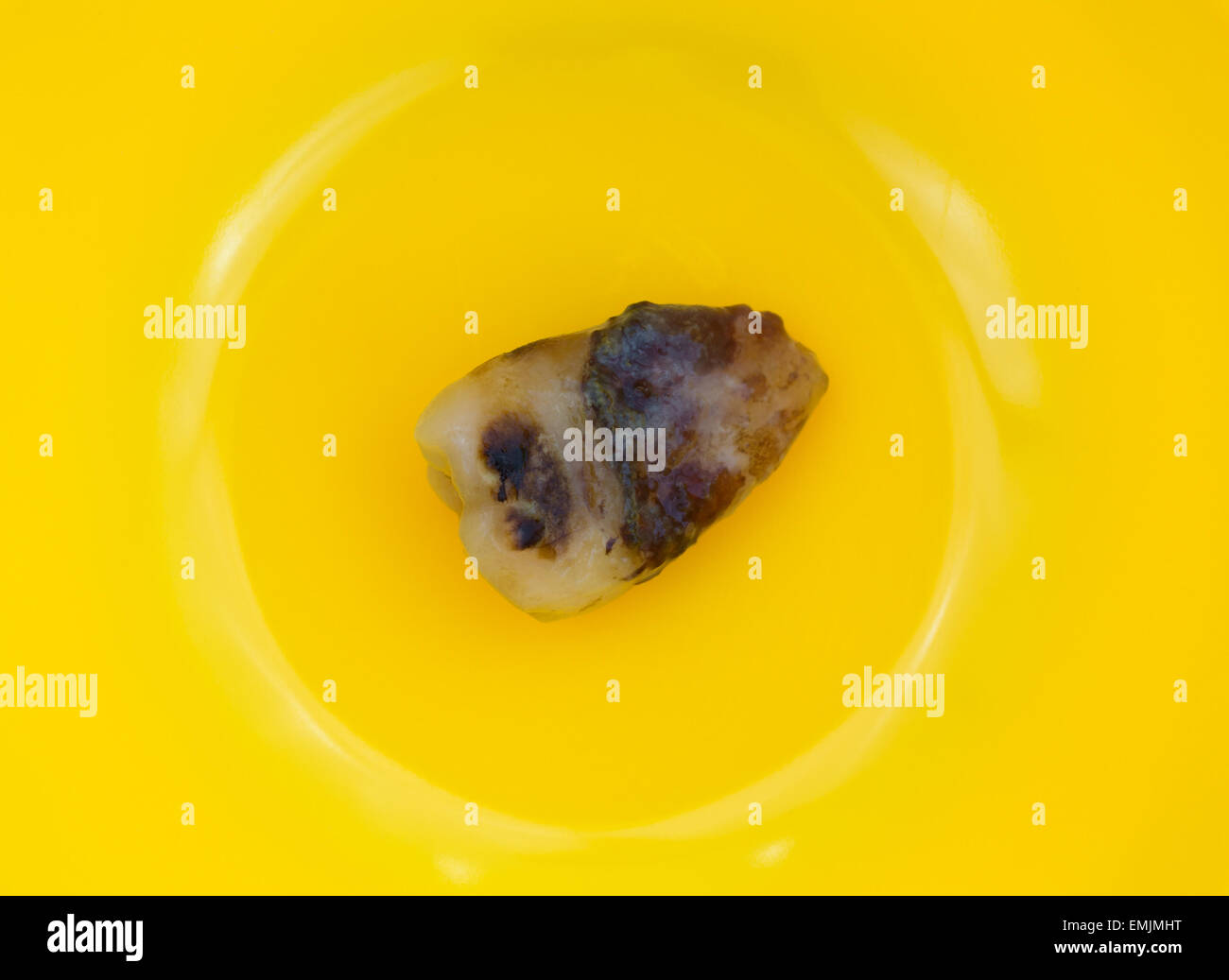 Wisdom tooth hi-res stock photography and images - Alamy