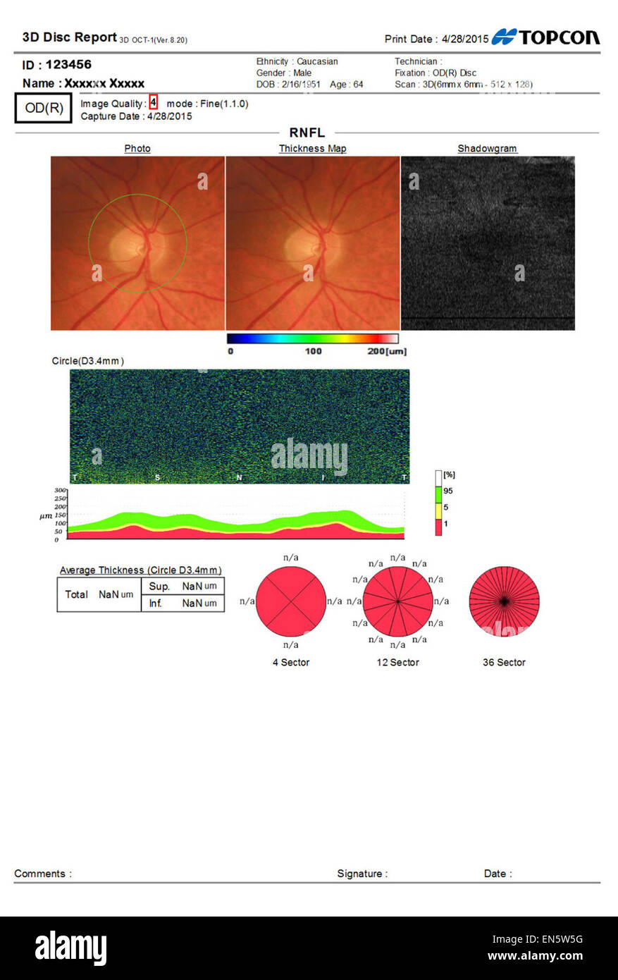 Eye scan ultra sound test showing 3D MACULA REPORT of human eye vist ...