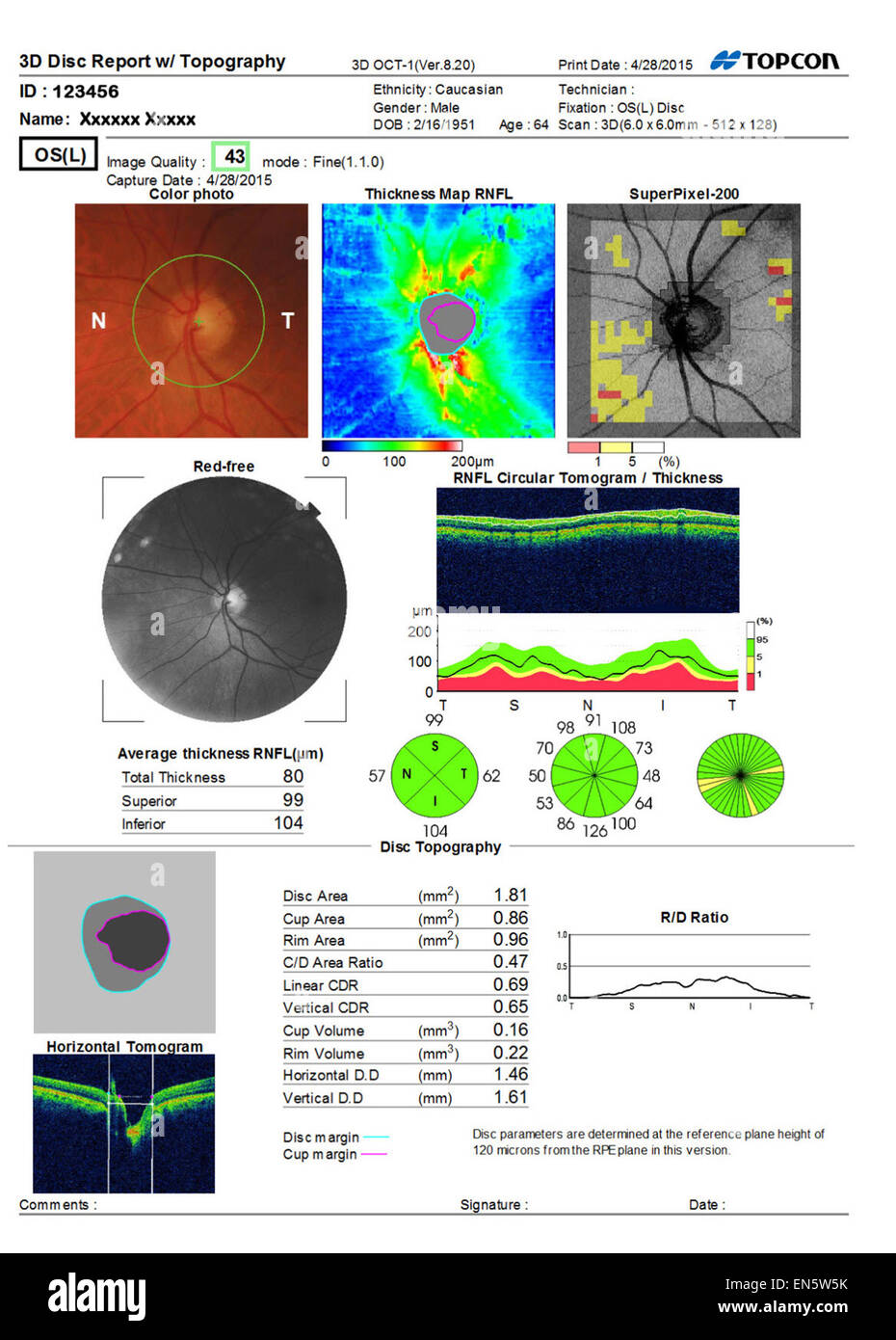 Eye scan ultra sound test showing 3D MACULA REPORT of human eye vist ...